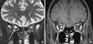 Idiopathic inflammatory-demyelinating diseases of the central nervous system | SpringerLink