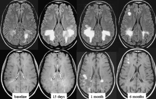 Idiopathic inflammatory-demyelinating diseases of the central nervous system | SpringerLink