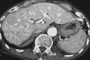 Manganese accumulation in the brain: MR imaging | SpringerLink