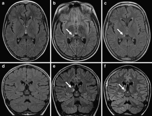 Thalamus lesions in chronic and acute seizure disorders | SpringerLink