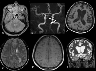 Neurosyphilis: MRI features and their phenotypic correlation in a ...