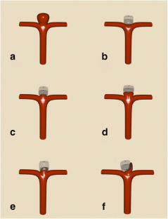 Woven Endobridge (WEB) Device for endovascular treatment of ruptured ...