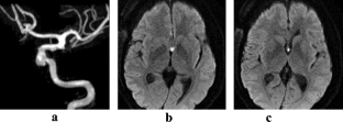 Subcallosal artery stroke: infarction of the fornix and the genu of the ...