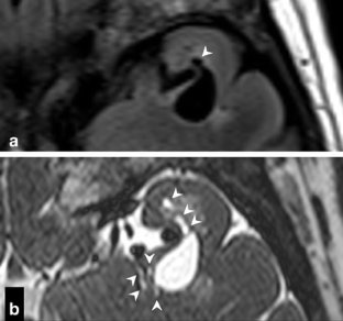 Large anterior temporal Virchow-Robin spaces: unique MR imaging ...