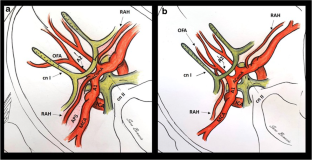 Embryology and variations of the recurrent artery of Heubner | SpringerLink