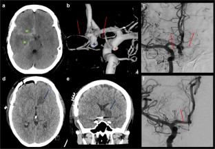Embryology and variations of the recurrent artery of Heubner | SpringerLink
