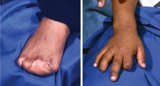 Surgical treatment of a severe microstomia developed following ...