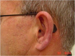 Caudal Antia–Buch reconstruction for helical defect reconstruction ...