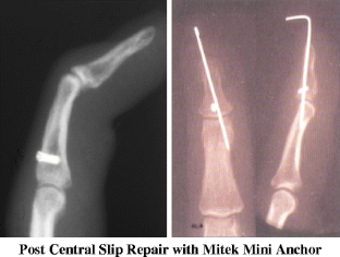Repair of the central slip of extensor tendon and the open mallet using ...