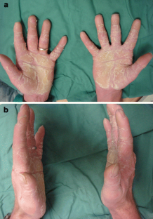 Congenital tylosis and the role of the plastic and reconstructive ...