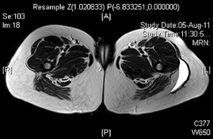 The Morel-Lavallee lesion: a review and a proposed algorithmic approach ...