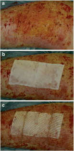 One-step grafting procedure using artificial dermis and split-thickness ...