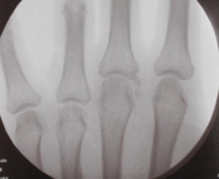 Reconstruction of the radial collateral ligament of the ...