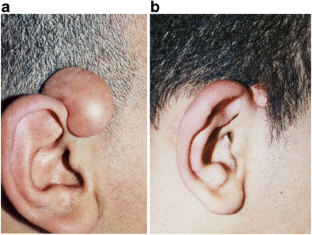 Intralesional cryosurgery for the treatment of keloid scars following ...