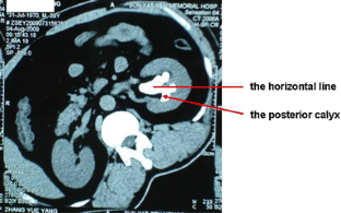 Percutaneous nephrolithotomy in semisupine position: a modified ...