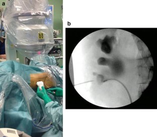 Invited review: the tale of ECIRS (Endoscopic Combined IntraRenal ...