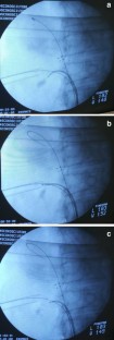 Invited review: the tale of ECIRS (Endoscopic Combined IntraRenal ...
