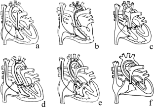 Autoregulation of Cerebral Blood Flow in Fetuses with Congenital Heart ...