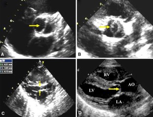 Atypical Shone’s Complex Diagnosed by Echocardiography | SpringerLink