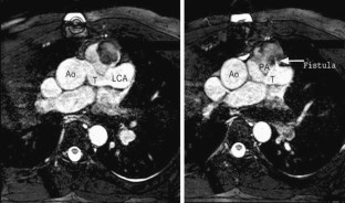 Late Complications After Takeuchi Repair of Anomalous Left Coronary ...