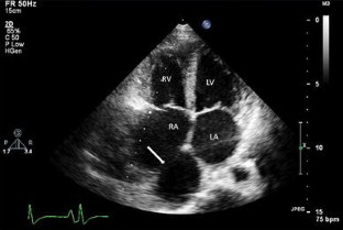 Cor Triatiratum Dexter: A Rare Cause of Isolated Right Atrial ...