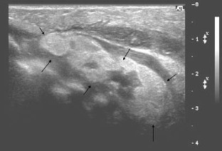 Imaging findings in subcutaneous fat necrosis in a newborn | SpringerLink