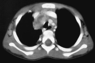 Comparing axillary and mediastinal lymphadenopathy on CT in children ...