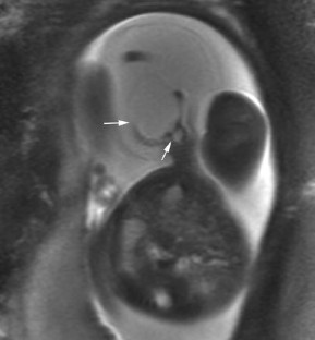 Allantoic cyst: a prenatal clue to patent urachus | SpringerLink