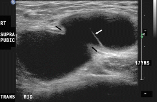 Sonographic appearance of canal of Nuck hydrocele | SpringerLink