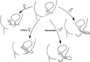 Imaging of hypospadias: pre- and postoperative appearances | SpringerLink