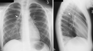Atypical intrathoracic rib in a pediatric patient requiring helical CT ...
