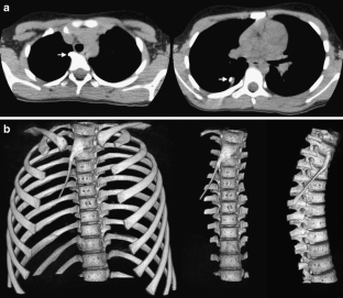 Atypical intrathoracic rib in a pediatric patient requiring helical CT ...
