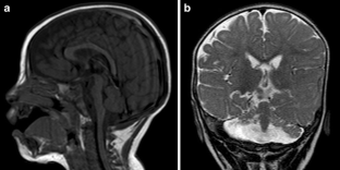 Microcephaly: a radiological review | SpringerLink