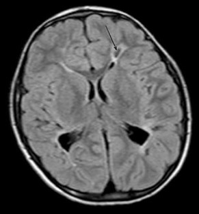 Microcephaly: a radiological review | SpringerLink