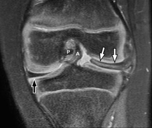 MRI of the knee: key points in the pediatric population | SpringerLink