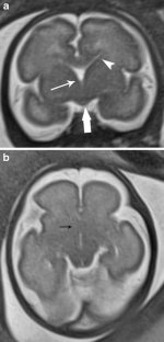 Thick corpus callosum: a clue to the diagnosis of fetal septopreoptic ...