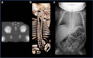 Prenatal diagnosis of fetal skeletal dysplasia with 3D CT | SpringerLink