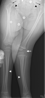 Growth arrest and leg-length discrepancy | SpringerLink