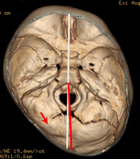 Craniosynostosis: imaging review and primer on computed tomography ...