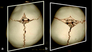 Craniosynostosis: imaging review and primer on computed tomography ...