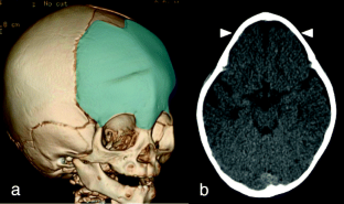 Craniosynostosis: imaging review and primer on computed tomography ...