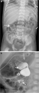 Case 1: a newborn with bilious emesis | SpringerLink