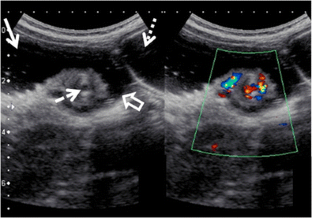 Case 1: a newborn with bilious emesis | SpringerLink