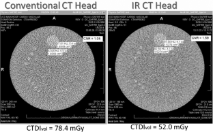Iterative reconstruction: how it works, how to apply it | SpringerLink