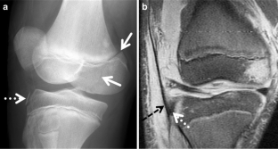 Avulsion fractures of the pediatric knee | SpringerLink