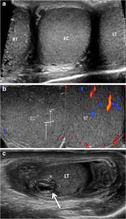 Extratesticular masses in children: taking ultrasound beyond ...