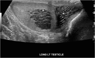 Extratesticular masses in children: taking ultrasound beyond ...