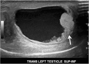 Extratesticular masses in children: taking ultrasound beyond ...