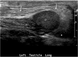 Extratesticular masses in children: taking ultrasound beyond ...