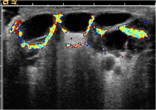 Extratesticular masses in children: taking ultrasound beyond ...